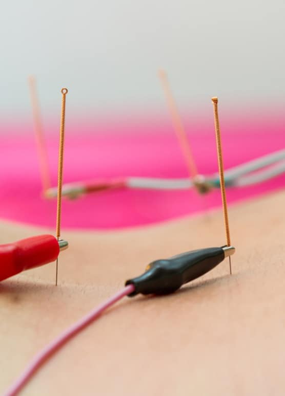 Electro-Acupuncture – Soma Acupuncture